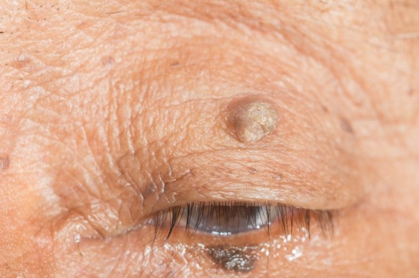 Skin Imperfections Removal Treatments Falkirk