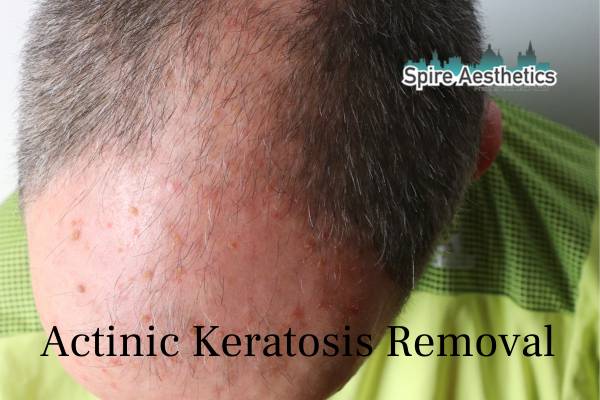 Actinic Keratoses Removal Falkirk Book In NOW